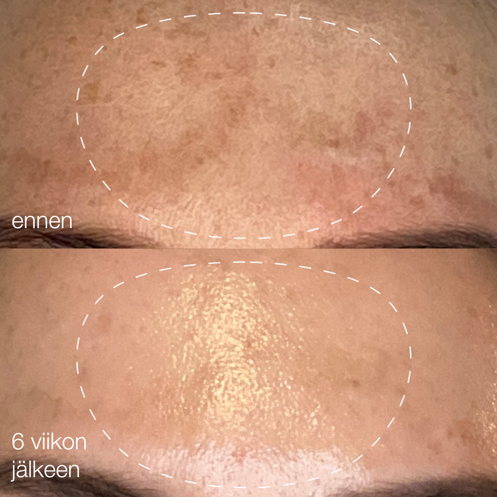 melanopro peel system | Dermalogica Suomi PRO